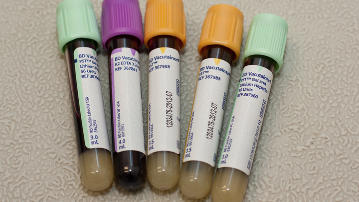 A massive discovery for depression diagnosis - Starts at 60