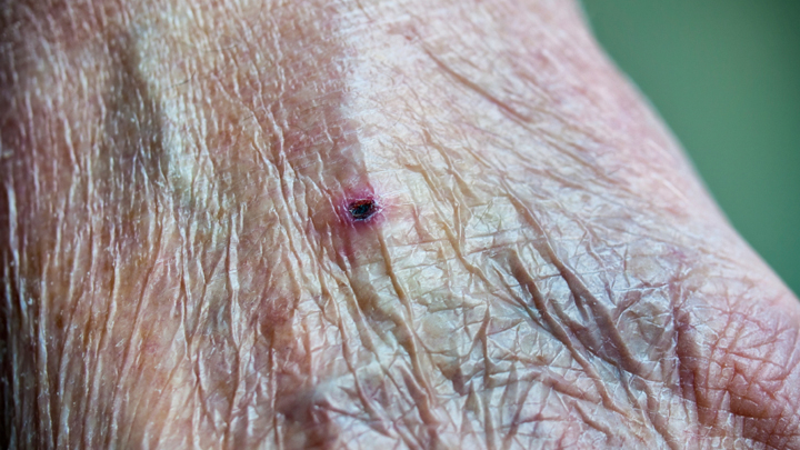 Preventing and treating dry, paper thin skin tears - Starts at 60