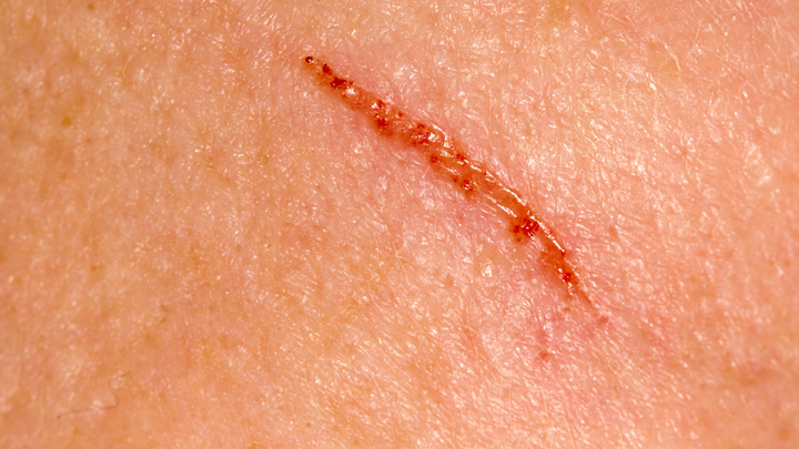 How to prevent and treat skin tears easily - Starts at 60