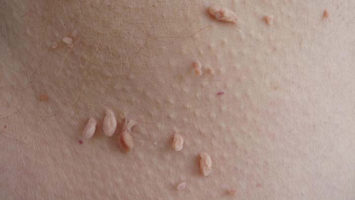 The simple remedy that will get rid of your skin tags - Starts at 60