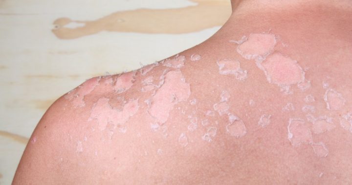 6 tips to soothe your sunburnt skin - Starts at 60