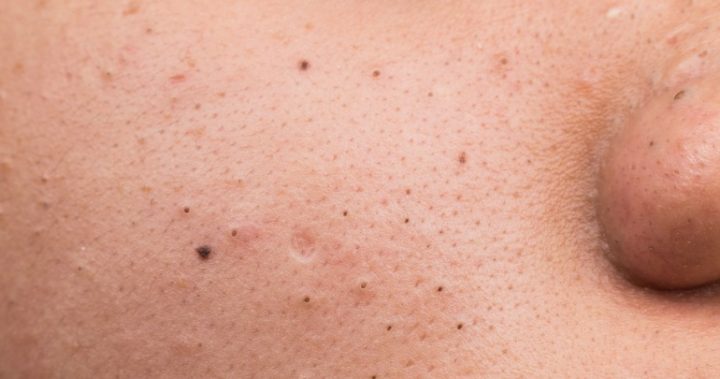 Check out this completely natural blackhead removal technique - Starts ...